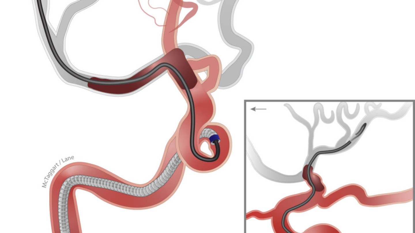 Emergent Large Vessel Occlusion (ELVO) | Neurosurgery | Medical School ...